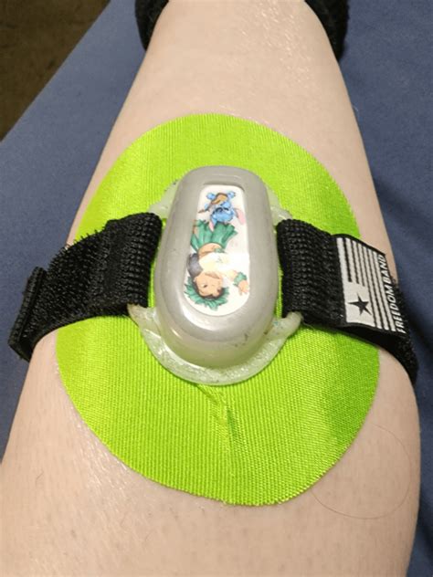 Dexcom Gmi Compared To A1c R Dexcom