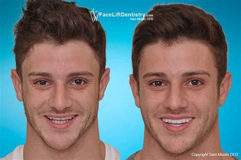 Deep Overbite Correction Causes Symptoms And Treatment