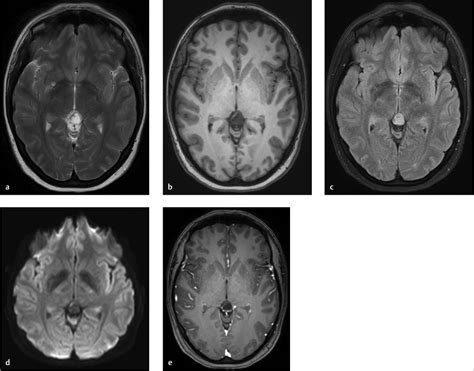 Pineal Gland Mri
