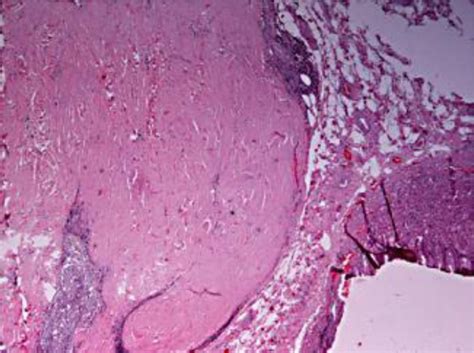 Gastric Calcifying Fibrous Tumor H E ×100 Download Scientific Diagram