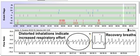 Beyond Ahi Apneas And Hypopneas In The Flow Rate Graph Apnea Board Wiki