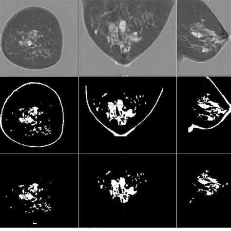 steps in the quantitative breast density algorithm top row speed of