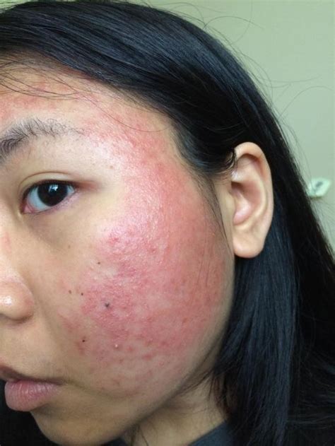 Allergic Reaction Rash On Face