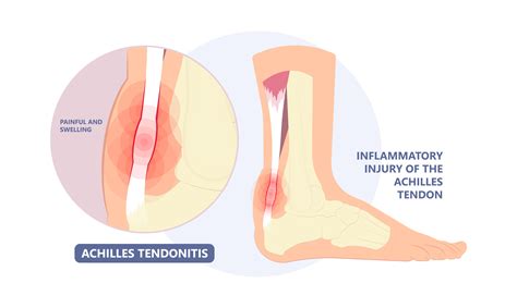 Achilles Tendonitis Romeo Mi Washington Foot And Ankle