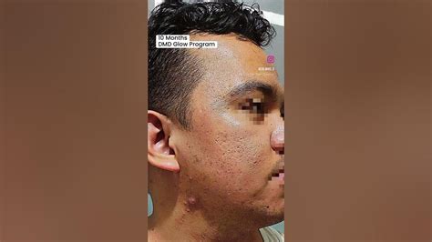 Acne Acne Scar Atrophoderma Vermiculatum 6 Months Of Dmd Topicals 👉🏻