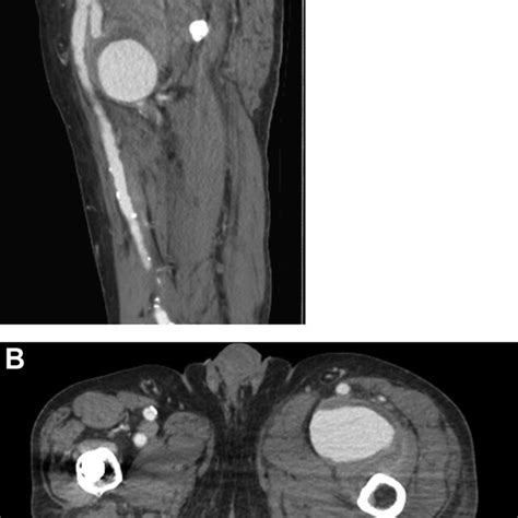 A Preoperative Sagittal Computed Tomography Angiography Demonstrating