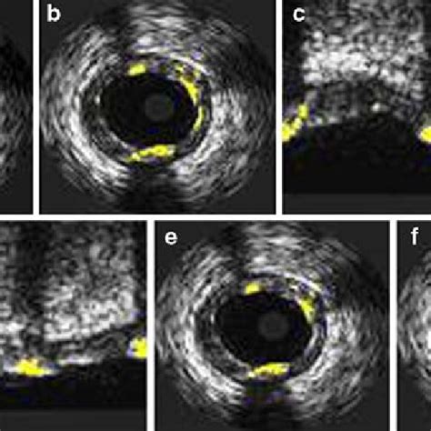 Characterizing Calcified Region A Ivus Image B High Intensity Plaque Download Scientific
