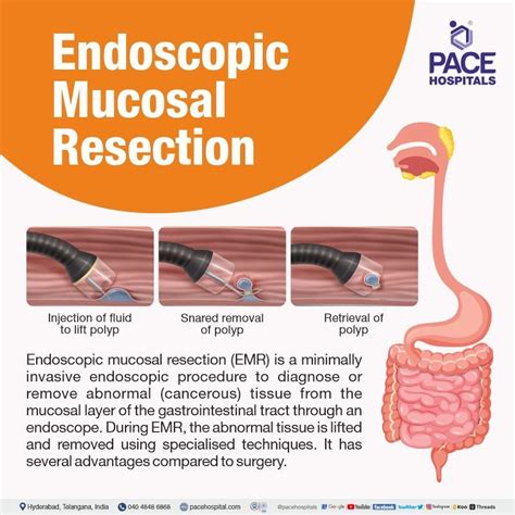 Endoscopic Mucosal Resection In Hyderabad India Indications And Cost