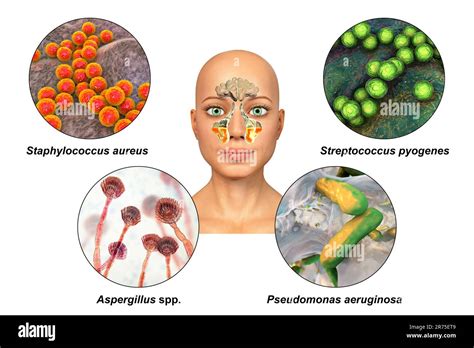 Anatomy Of Rhinosinusitis And Microorganisms That Cause Sinusitis
