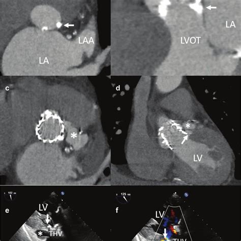 Pdf How Valvular Calcification Can Affect The Outcomes Of
