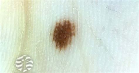 Dermoscopy Parallel Diffuse Pattern Acral Naevus Image Dermoscopy Parallel Diffuse Pattern Acral Naevus Image