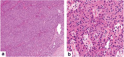 Oncocytic Variant Was One Of The Prototypical Examples Of The Download Scientific Diagram