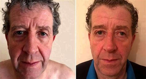 Male Liquid Facelift Before And After Facelift Info Prices Photos Reviews Q A