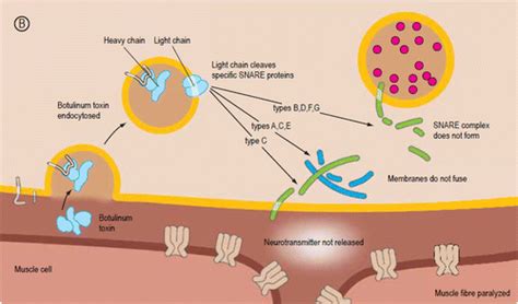 Neurotoxin Complex Botulinum Toxin Type A Injection For Botulinum Toxin