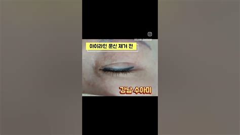 아무 생각 없이 기계가 알아서 지워 주겠지 생각 안하고 횟수 최대한 늘려 제거 하지 않습니다 🙂 문신제거 아이라인제거 아이