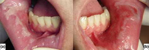 Oral Chlamydia