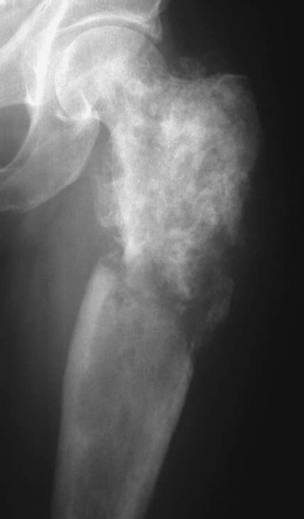 Malignant Bone Tumours Clinical Tree