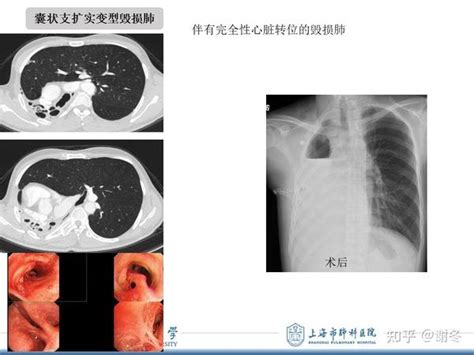毁损肺是什么能手术吗应该如何治疗 知乎