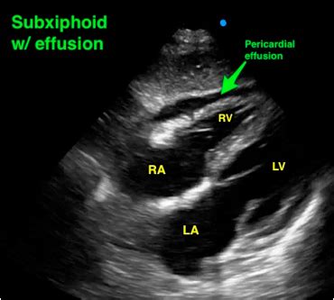 Subxiphoid Pericardial Window