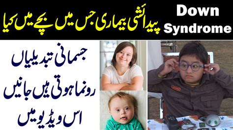 پیدائشی بیماری جس میں بچے میں کیا جسمانی تبدیلیاں رونما ہو تی ہیں جانیں