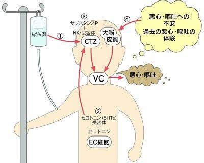 がん化学療法の副作用ー食欲不振悪心嘔吐へのケア ナース専科