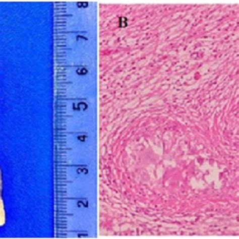 A Gross Picture Of The Inflamed Appendix Showing Luminal Obstruction A Gross Picture Of The Inflamed Appendix Showing Luminal Obstruction