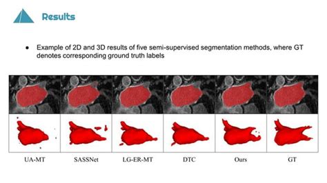 Embc 2021 Hierarchical Consistency Regularized Mean Teacher For Semi Supervised 3d Left Atrium