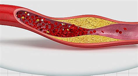 경동맥 협착증 증상과 원인 치료법 알아보기 네이버 블로그