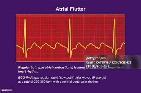 Ecg In Atrial Flutter Illustration High Res Vector Graphic Getty Images
