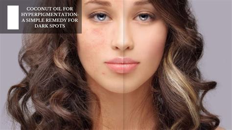 Coconut Oil For Hyperpigmentation A Simple Remedy For Dark Spots Moksha Lifestyle Products