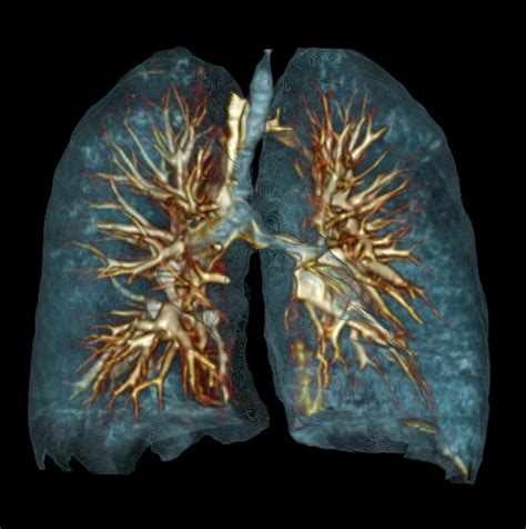 Emphysema 3d Ct Scan By Science Photo Library