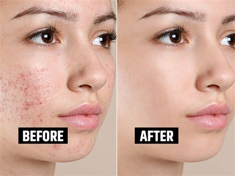 How To Remove Pimples Spots पपलसमळ चहऱयवर कळ डग खडड पडलत ३ उपय चहर दसल