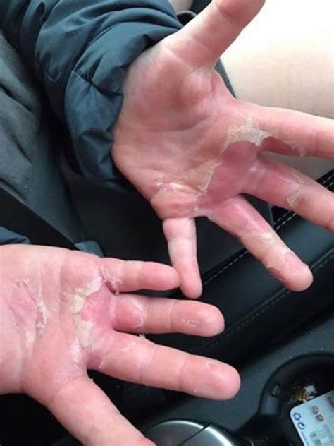 La Peligrosa Tendencia De La Masa Pegajosa Que Ocasiona Quemaduras