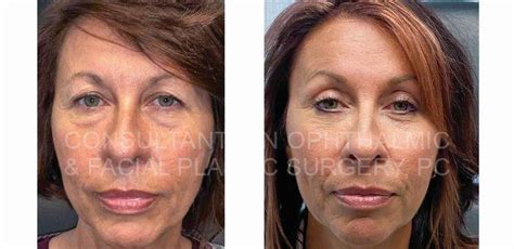 Endoscopic Forehead And Brow Lift Transconjunctival Excision Herniated Orbital Fat With Co2