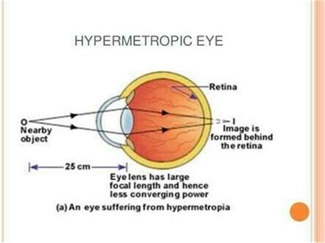Hyperopia Ray Diagram