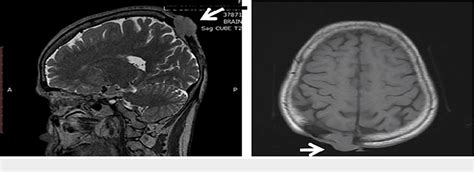 Figure 1 From Squamous Cell Carcinoma Scalp With Intracranial Extension Challenging Case Of