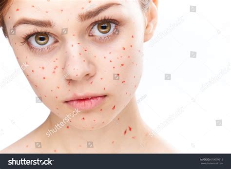 Woman Rash On Her Face Looks Stock Photo Shutterstock