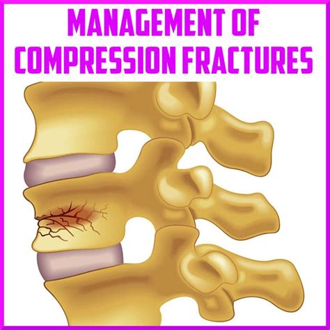 Spine Compression Fracture Exercises At Claude Harrod Blog