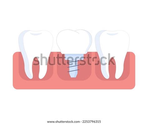 Healthy Tooth Dental Implant Human Teeth Stock Vector Royalty Free