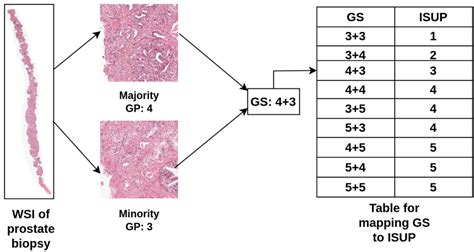 논문 리뷰 Efficient Self Supervised Grading Of Prostate Cancer Pathology