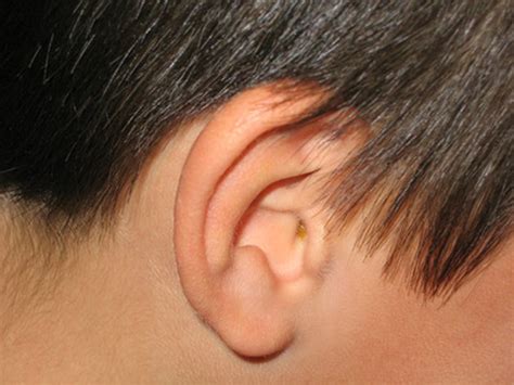 How To Prevent Ear Wax Build Up Livestrong Com