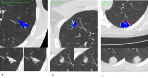 Figure 1 From Pulmonary Nodule Characterization A Comparison Of Conventional With Quantitative