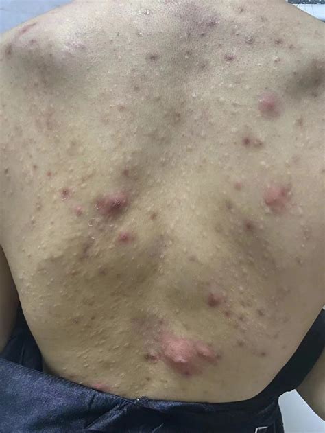 排毒长脓包痘痘 安疗网