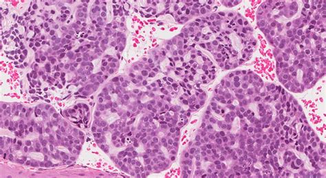 Basaloid Squamous Cell Carcinoma Of The Larynx Ottawa Atlas Of Pathology