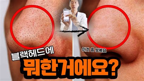 피부과 안가고 블랙헤드 없애기 홈케어 블랙헤드 제거 방법에 진실 Youtube