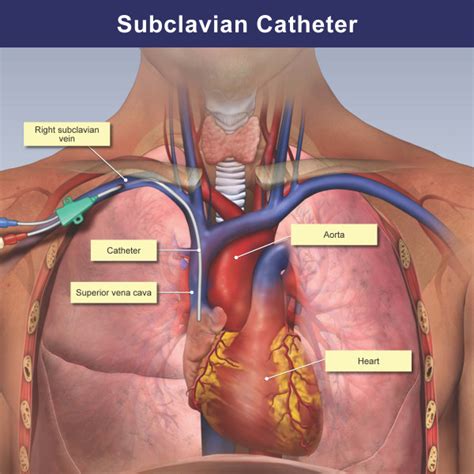 Pulmonary Embolism Comparison Trial Exhibits Inc