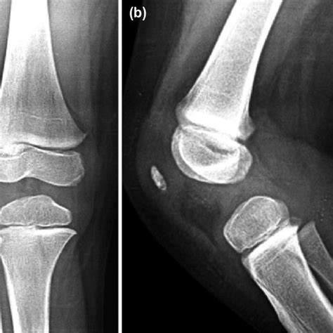 Pdf Aneurysmal Bone Cyst