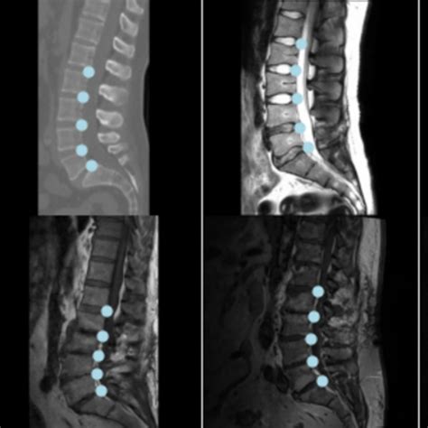 Lumbar Coordinate Dataset Kaggle