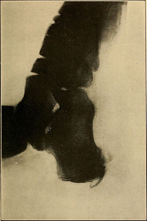 Foot Compression Fracture Treatment Seryflix