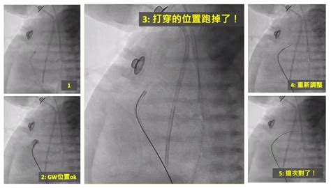 「學長，你怎麼能事先光看超音波就知道這個pda用piccolo 一種關閉器 會 兒童心臟會客室 聊聊孩子們的心事